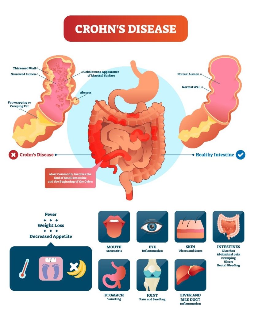 Crohn’s disease - Dr Neeraj Singh MD FACS FASCRS