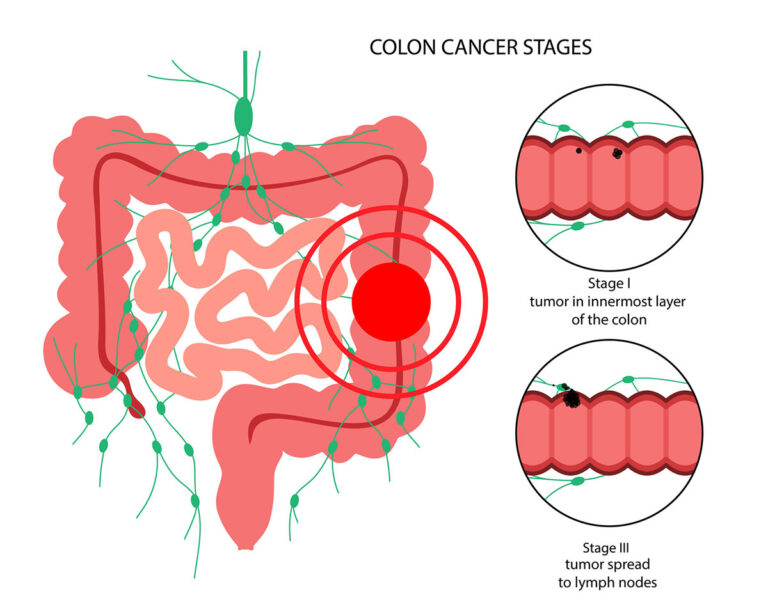Dr Neeraj Singh - Colon & Rectal Care Center of Phoenix
